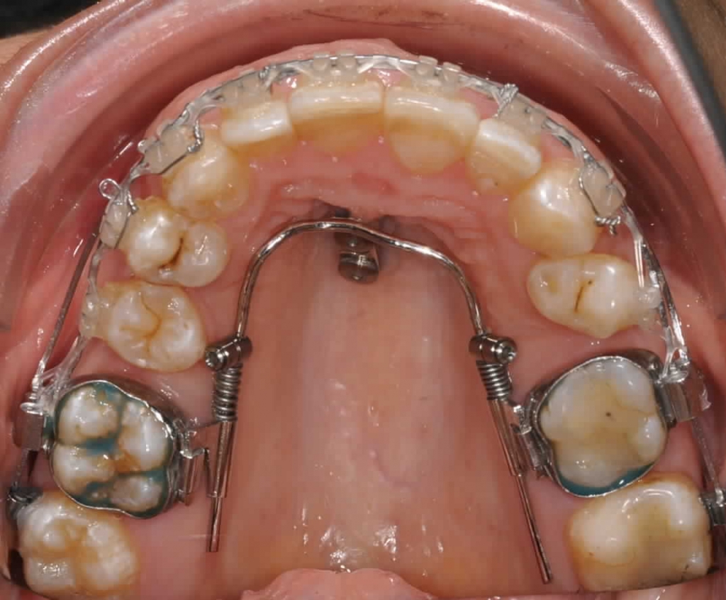 Mini-Implantate – Praxis für Kieferorthopädie Dr. Ines Graf